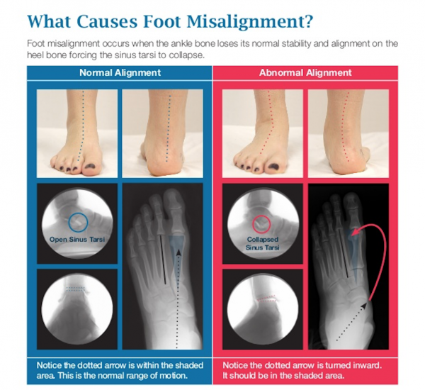 Everything You Need to Know about Misaligned Feet - Foot and Ankle Group
