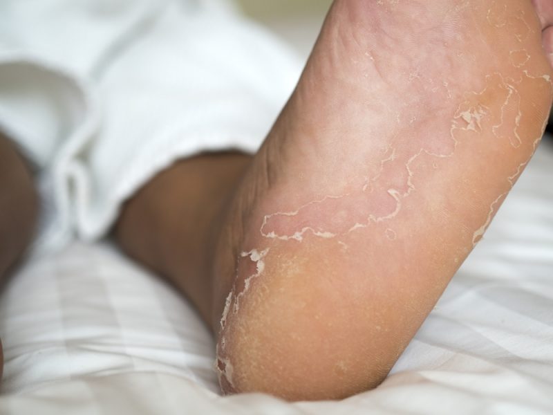 4 Common Foot Skin Problems & Treatments - Foot and Ankle Group