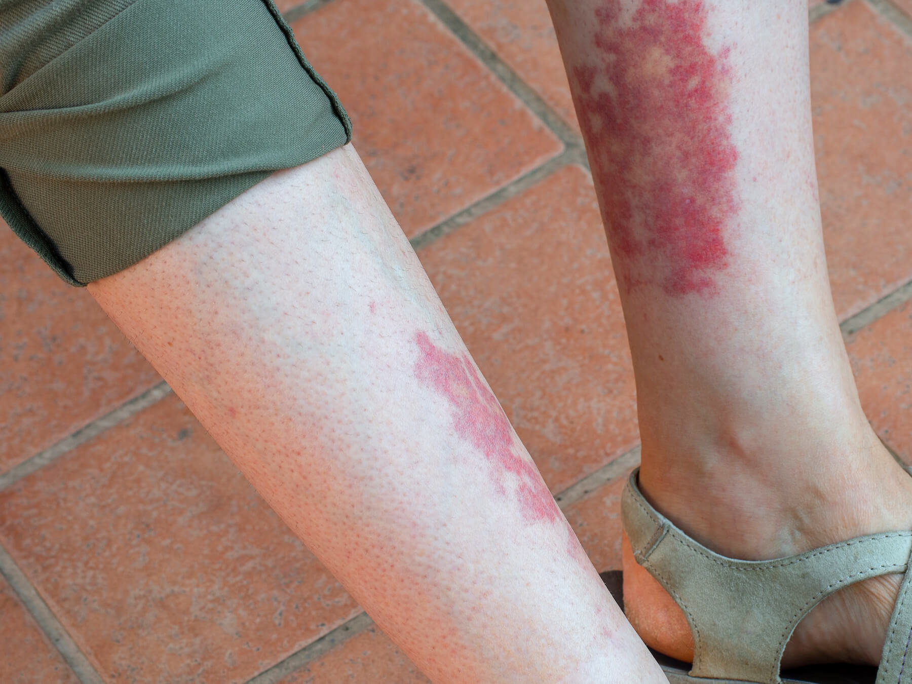 The Disney Rash Explained - Foot and Ankle Group