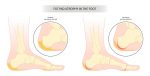 How To Treat Foot Pad Atrophy - Foot and Ankle Group