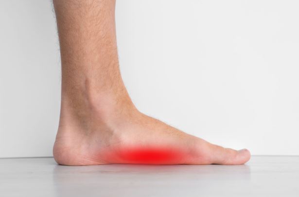 Understanding Fallen Arches - Foot and Ankle Group